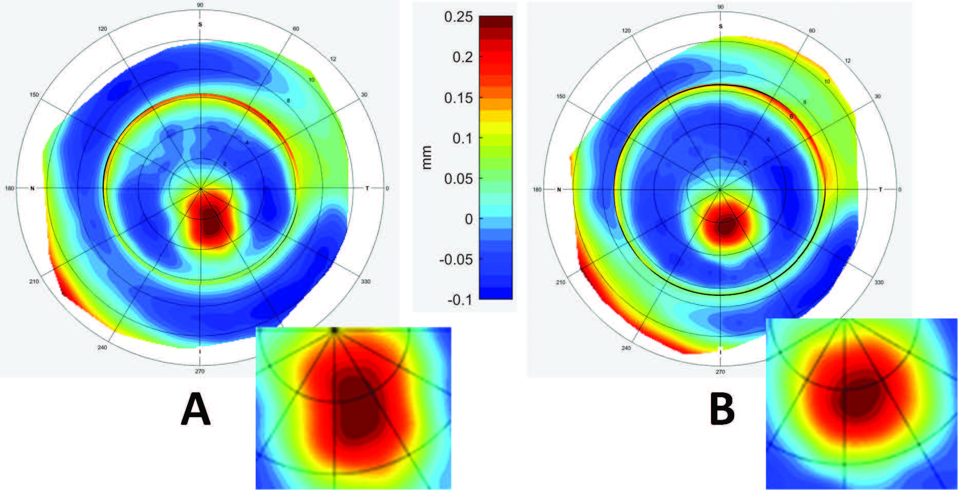 Collagen Crosslinking (CXL) Can Change Scleral Shape - Visionary Optics