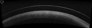 Clearing the Mist: How to Tackle Scleral Lens Fogging