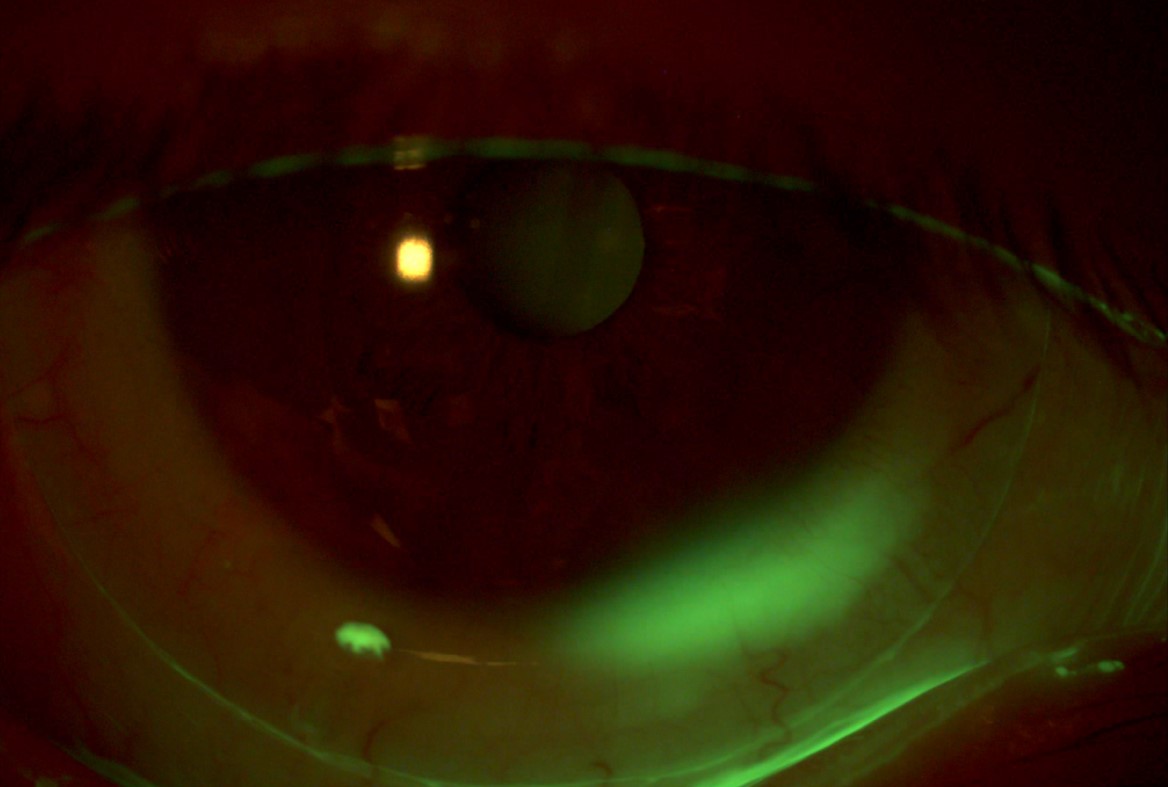 Clearing the Mist: How to Tackle Scleral Lens Fogging