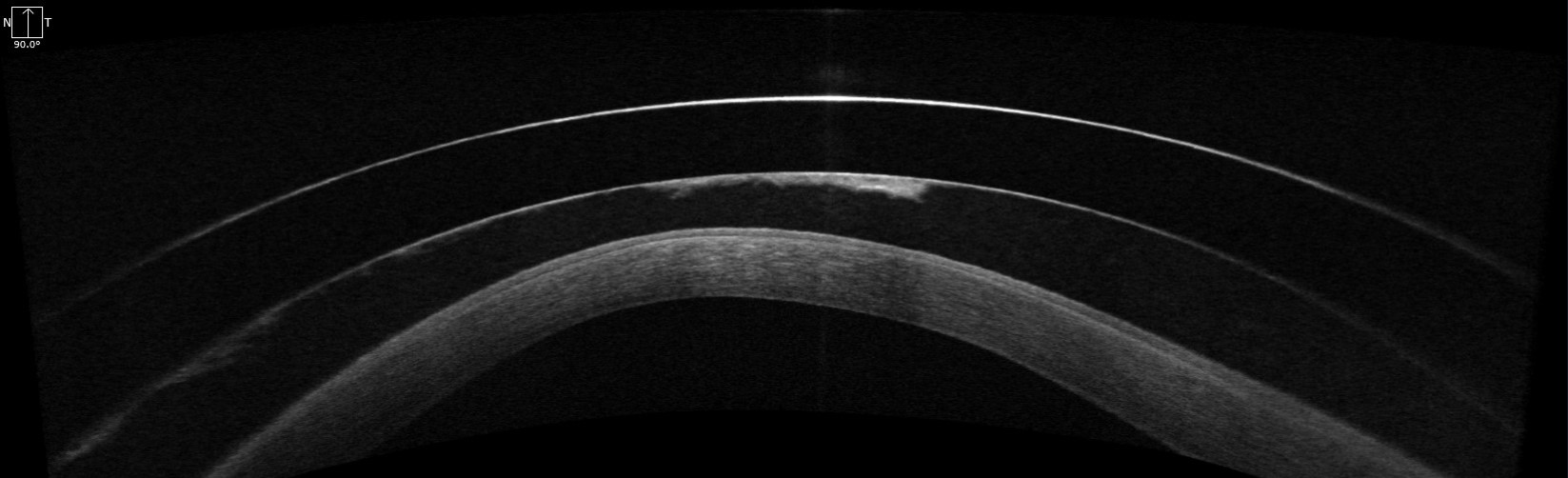 Clearing the Mist: How to Tackle Scleral Lens Fogging