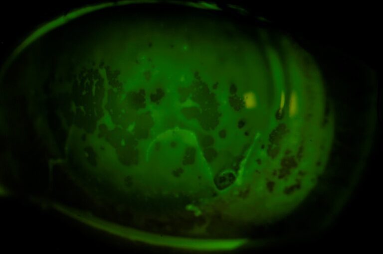 Clearing the Mist: How to Tackle Scleral Lens Fogging