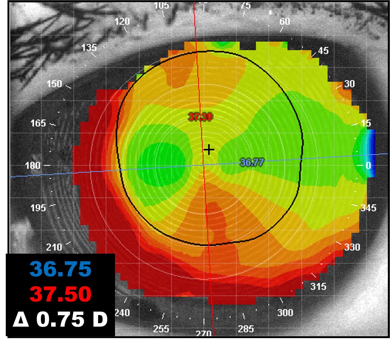 Journal Club: Flex Less: Enhancing Scleral Lens Stability and Optics ...